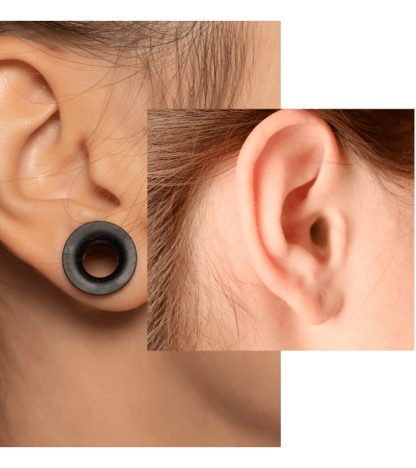 Ear Lobe Surgery | Stretched Earlobe Repair | Clinique Evolution